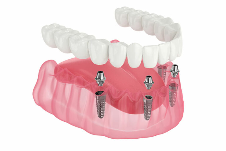 Full Mouth Dental Implants | Jacksonville, FL | Blue Sky Dental Group